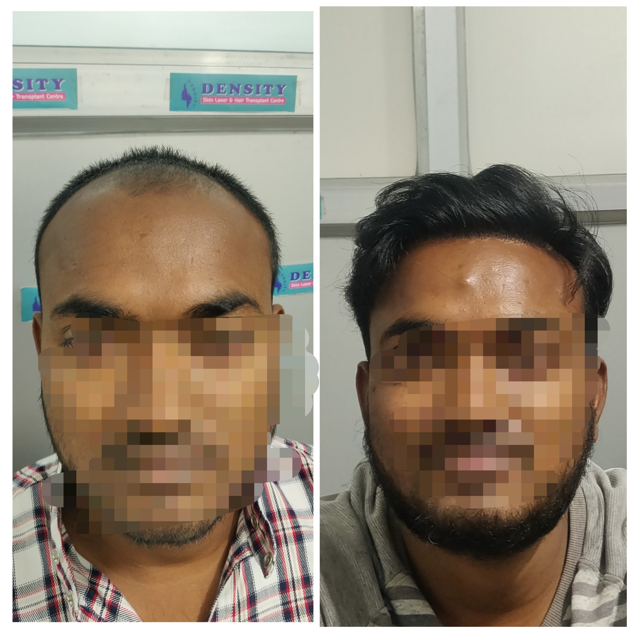 Density Hair transplant clinic: A Hidden Gem of the Hair Transplant ...