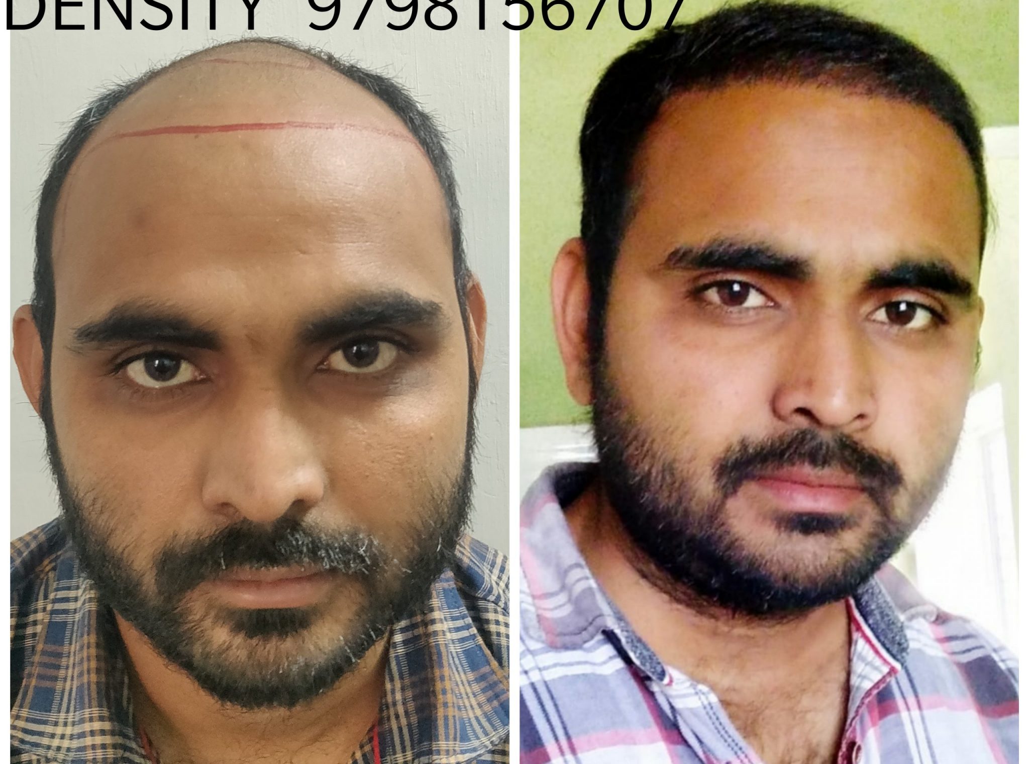 Density Hair transplant clinic: A Hidden Gem of the Hair Transplant ...