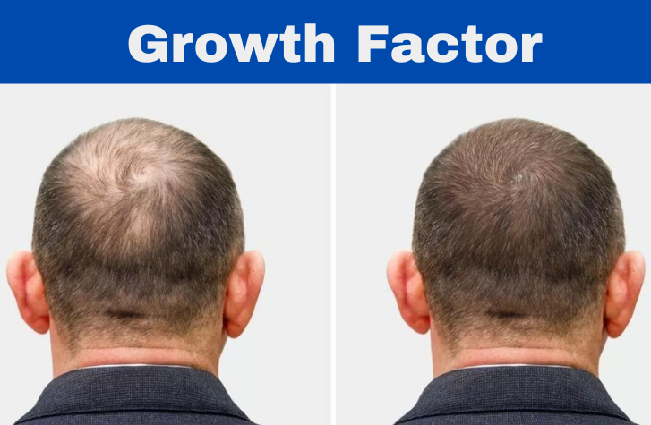 Why GFC Therapy Is Getting Popular As Compared To PRP Therapy For Hair ...