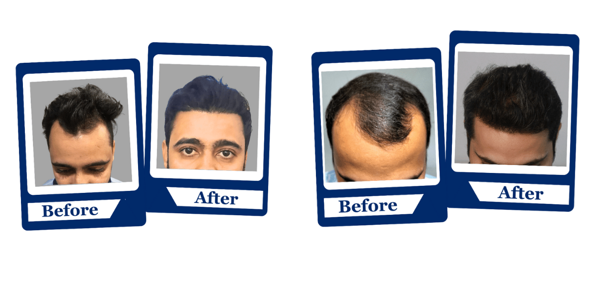 The Science Behind Hair Transplants: How It Works and Why It’s Effective ? - Best Hair Help