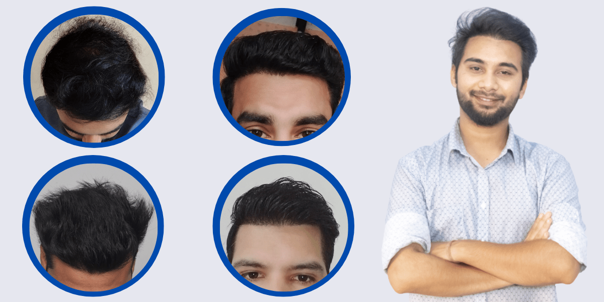 The Science Behind Hair Transplants: How It Works and Why It’s Effective ? - Best Hair Help