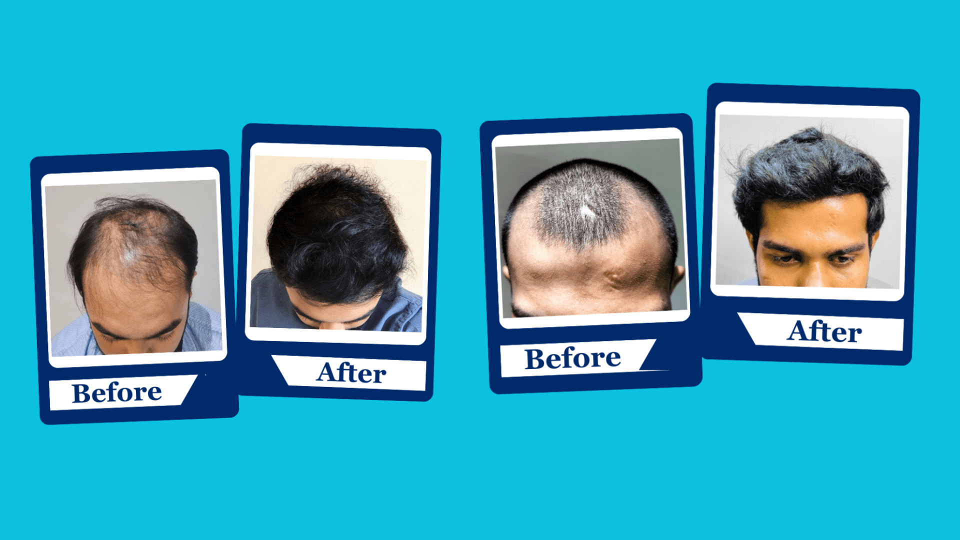 Hair Transplant in Kolkata - Best Hair Help