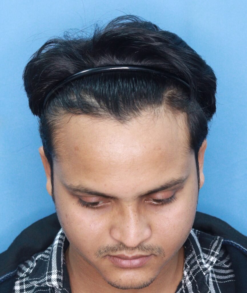 The Most Natural Hairline One Can Ever Get After Hair Transplant ...